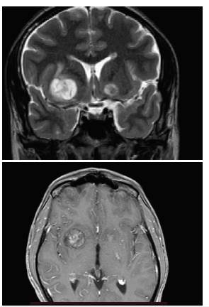 Criptococosis meníngea