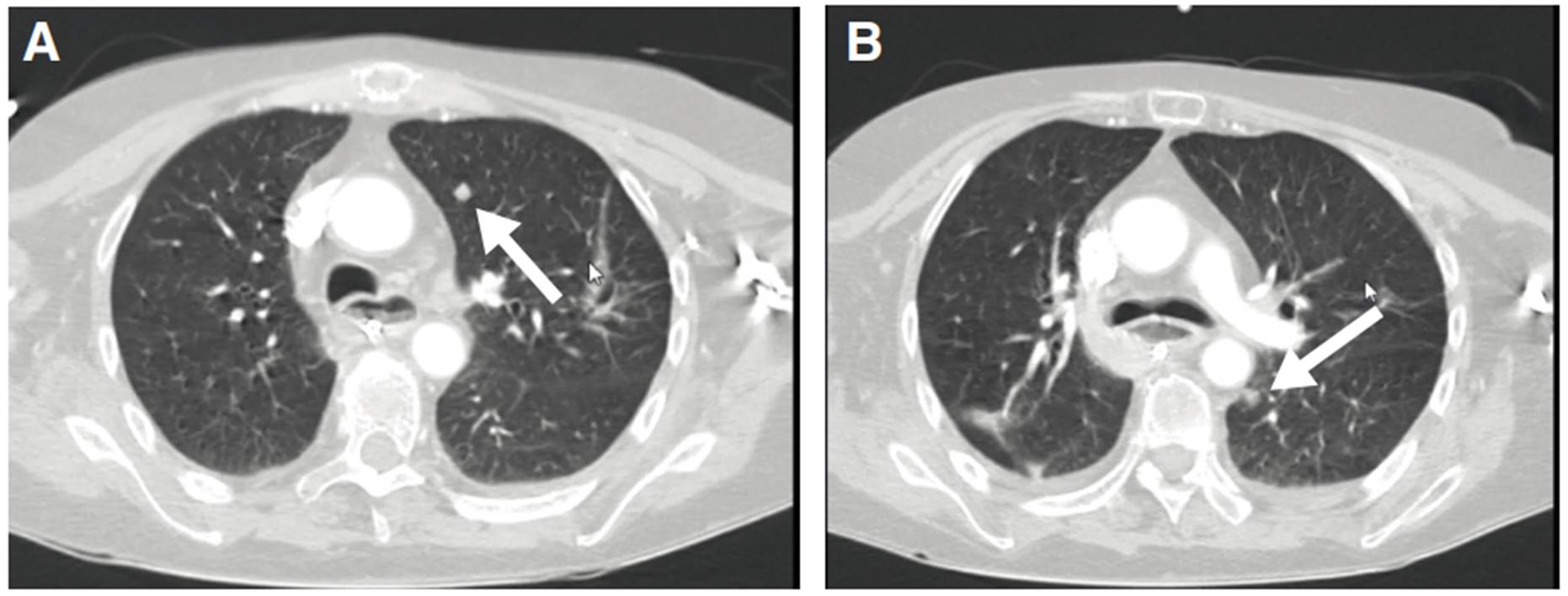 Criptococosis diseminada por terapia biológica, se debe gestionar el riesgo.