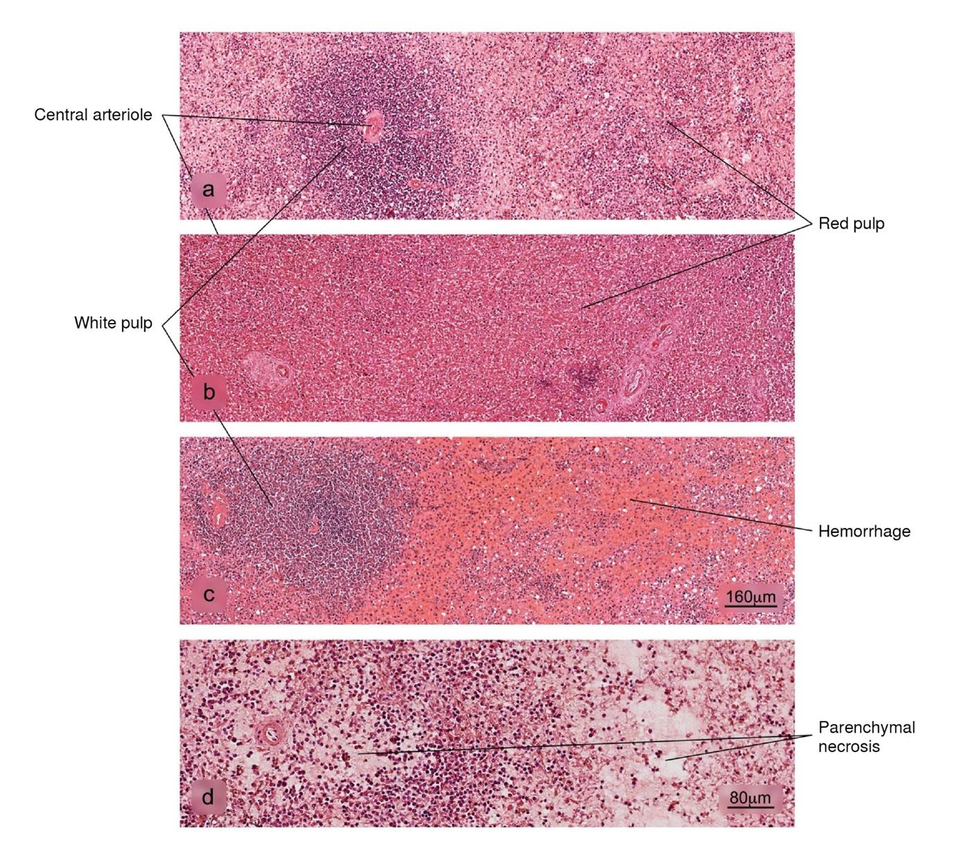 Histopathology Of COVID 19 An Illustration Of The Findings From Fatal Histopathology Of COVID 19 An Illustration Of The Findings From Fatal
