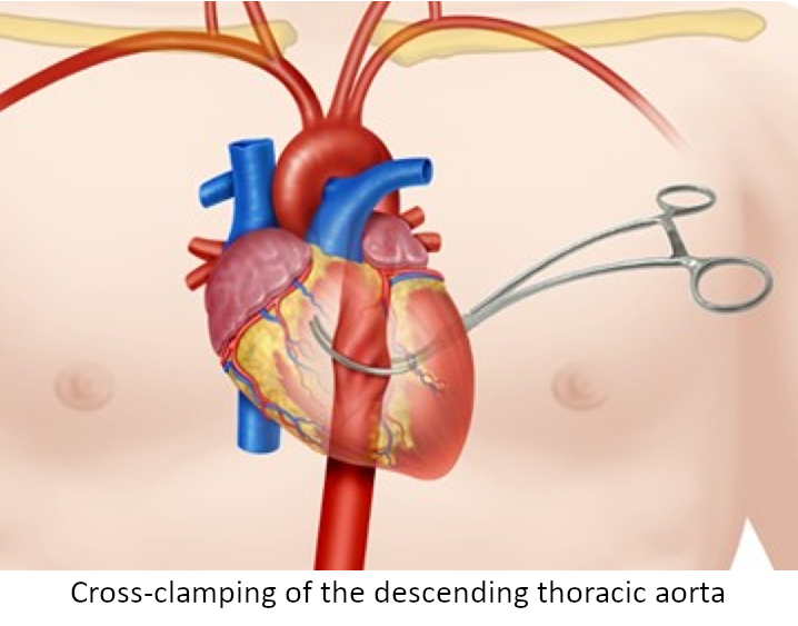 Hemodynamically unstable non-compressible penetrating torso trauma: a practical surgical approach