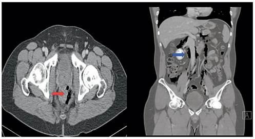 Trauma de recto penetrante: revisión de tema