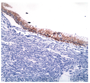 Neoplasias Quísticas Mucinosas Del Páncreas Caso Clínico Y Revisión De