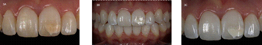 Typical esthetic outcomes using 5 different modalities to treat MIH affected teeth: a case series